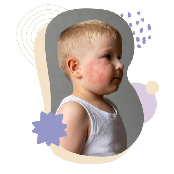 Understanding Hypoallergenic Baby Formulas for Allergic Infants